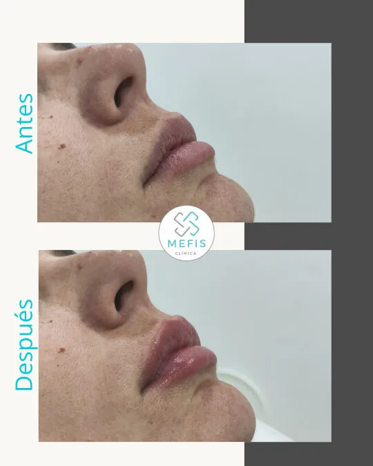 Dermapen Labios: Descubre el Secreto para unos Labios Perfectos
